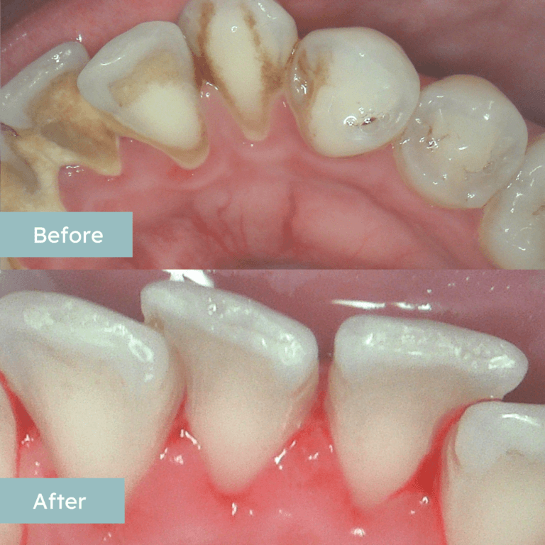 Scaling GBT Airflow Smart Dental – Smart Dental